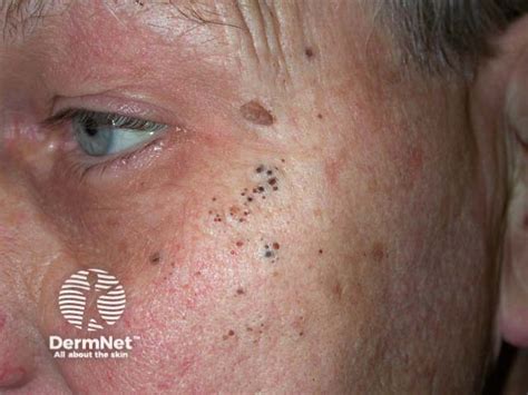Favre Racouchot Syndrome Image