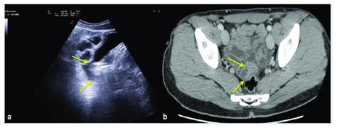 Transverse Us Image Of The Left Hypochondrium A Shows A Large Download Scientific Diagram