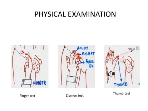 Type I Sliding Inguinal Hernia The Posterolateral Aspect