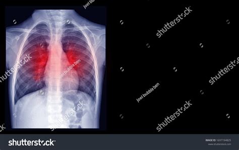 Bronchitis Chronic Radiography Over 57 Royalty Free Licensable Stock