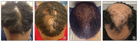 Central Centrifugal Cicatricial Alopecia In Males Analysis Of Time To