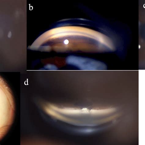 Gonioscopic View Of Right Eye Showing That The Angle Was Open With