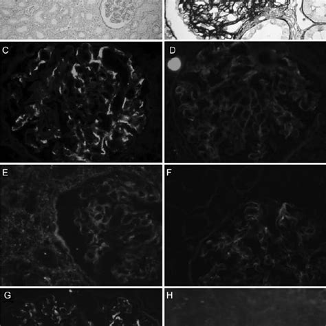 Microscopic Analysis Of Renal Biopsy Specimens Of Our Pgnmid Case