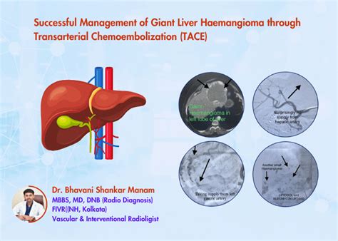 Transarterial Chemoembolization Tace