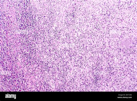 Histopathology Of Chronic Cholecystitis Light Micrograph Hematoxylin And Eosin Staining Stock