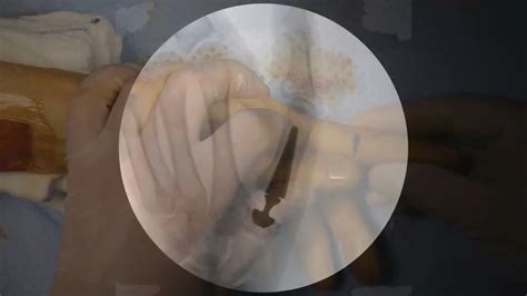 Touch Cmc 1 Total Joint Replacement Youtube