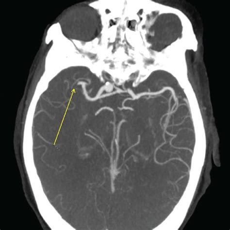 A B Ct Angiogram Of The Head Shows Abrupt Occlusion Of The Branch Of