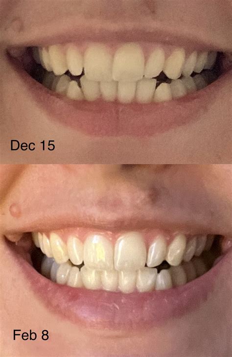 Lingual Inbrace Breezy Braces Progress Pic Scrolller