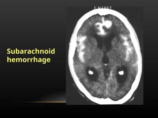 Radiological Anatomy Of Brain And Stroke Imaging Ppt