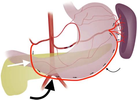 Splenic Artery Embolization Sae Dr Konika
