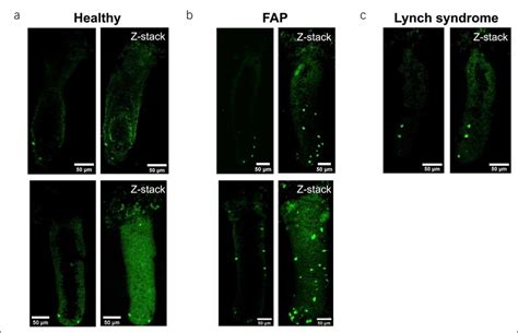 Lgr5 Staining In Crypts Of A Healthy Subject And Subjects With Crc Download Scientific Diagram