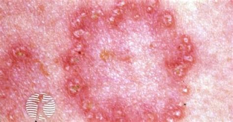 Elastosis Perforans Serpiginosa Image