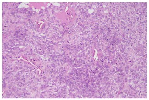 Short Spindle Shaped Tumor Cells With Blood Vessels In The Interstitium