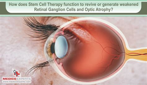 Optic Nerve Regeneration A New Frontier In Vision Restoration