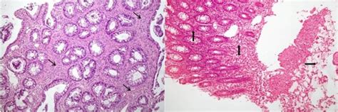 An Ulcerated Friable Mass Was Found On Endoscopy In The Upper Rectum Download Scientific