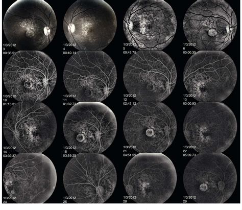 Figure 1 From Central Areolar Choroidal Dystrophy With Associated