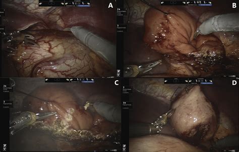 Wedge Gastrectomy Robot Assisted With Gastrotomy A The Tumor Was Download Scientific