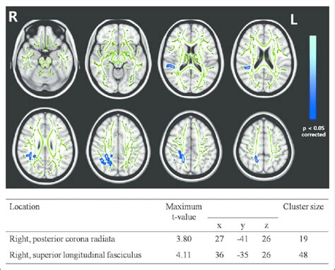Tract Based Spatial Statistics Results Of Mean Diffusivity Showing Download Scientific Diagram