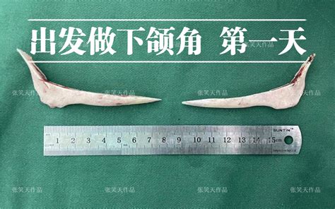出发做下颌角第一天 哔哩哔哩