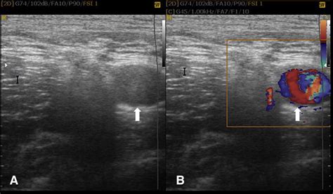 Pelvic Floor Trigger Point Injections The Floors