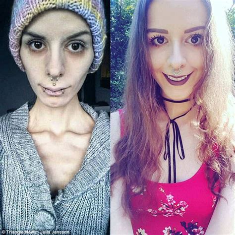 Recovering Anorexic From Zurich Hid Food In Her Ears Daily Mail Online