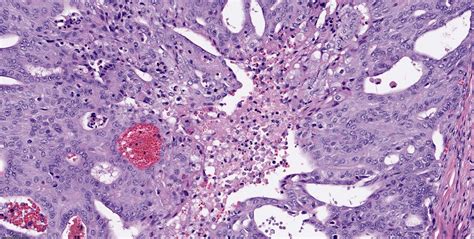 Pathology Outlines Case Of The Month 528