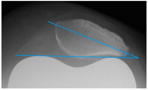 How To Fix Patellar Tilt At Victoria Horton Blog