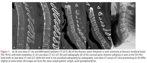 Bonemri Bonemri Spondyloarthritis Earlydetection Mri Mriguidance