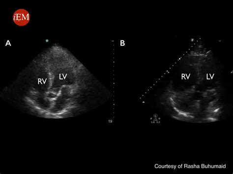 Video 7 Apical 4 Chamber Views With Normal And Abnormal Flickr