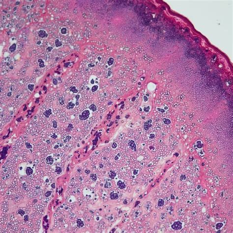 Squamous Cell Carcinoma Presence Stock Illustrations 1 Squamous Cell