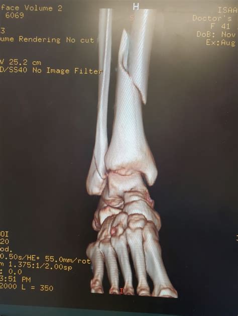 Compound Tib Fib Fracture
