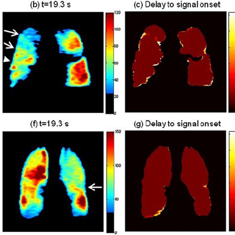 A Graphical Representation Of Collateral Ventilation Adapted From Hogg