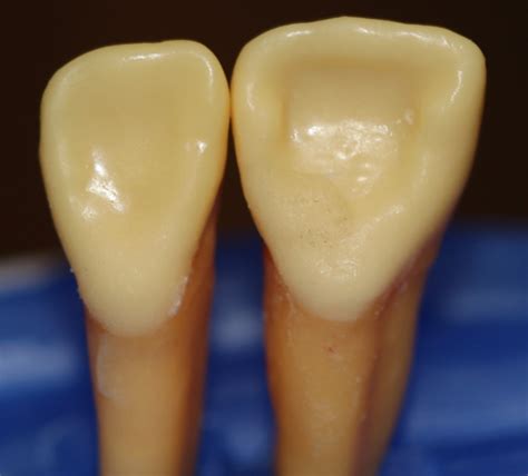 Maxillary Incisors Flashcards Quizlet