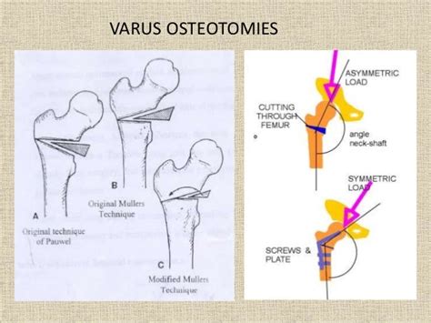 Osteochondritis Of Different Bones