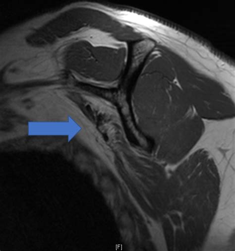Subscapularis Tear Classification Implications Regarding Treatment And Outcomes Consensus