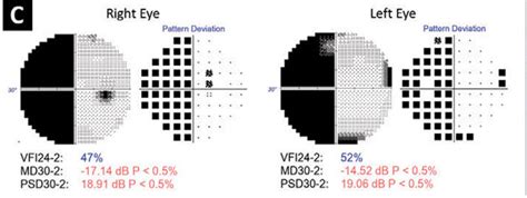 Stroke Visual Field