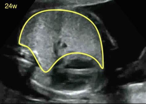 Fetal Thorax Anomalies Flashcards Quizlet