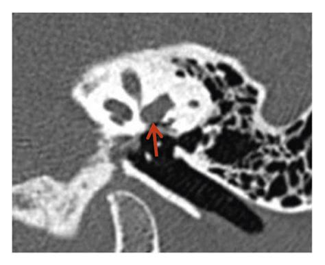 Malformation Of The Stapes Superstructure Without Footplate Fixation