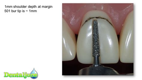 Incisor Mc Pfm Prep Enhanced Dental Cpd Online