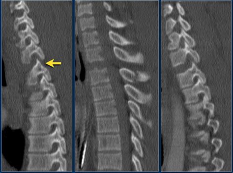The Radiology Assistant Tlics Classification Of Fractures