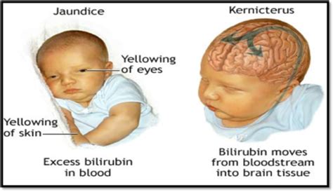 Hr Neonate Sg Flashcards Quizlet