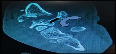 Intra Articular Distal Radius Fracture With Lunate Fossa Rotated And