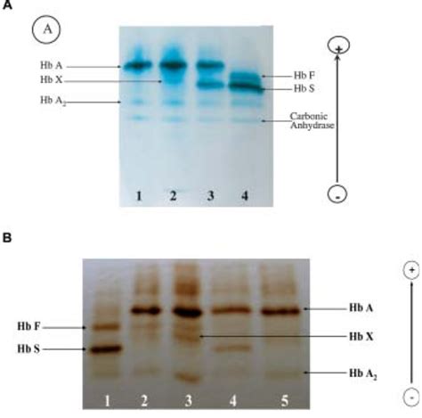 Cellulose Acetate Electrophoresis Principle And Application Microbe