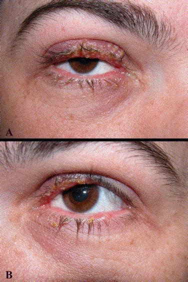 Pyodermatitis Pyostomatitis Vegetans Of The Eyelids Ophthalmology