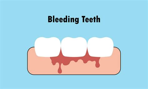 Bleeding White Teeth While Cleaning Because Brushing With Toothbrush