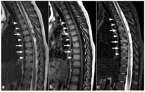 Compressed Spine Mri