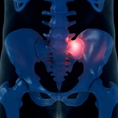 Evaluation And Management Of Sacroiliac Joint Dysfunction