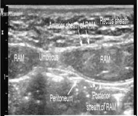 Sonoanatomy Of Rectus Abdominis Mucle Download Scientific Diagram