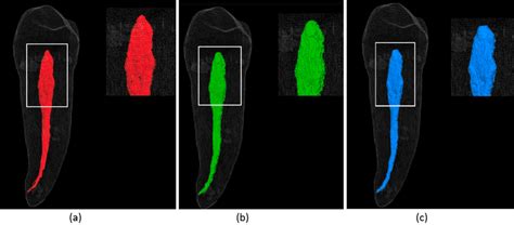 Premolar Root Canal Segmentation Results From A High Resolution µct