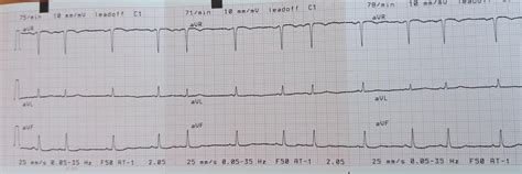 Ecg Of A 72 Years Old Hypertonic Female Patient According To Her Her